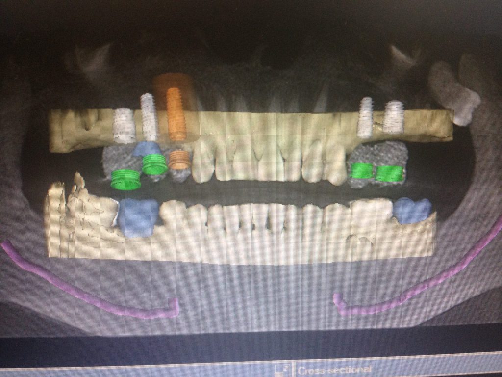 Sirona XG® 3D / Implants – Complete Dental of Mobile