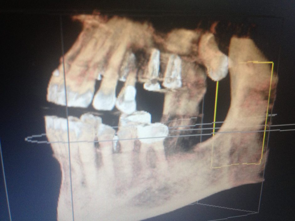 Sirona XG® 3D / Implants – Complete Dental of Mobile